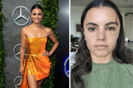 Hayley Erbert Was Terrified By Her Facial Change After Car Crash With ...